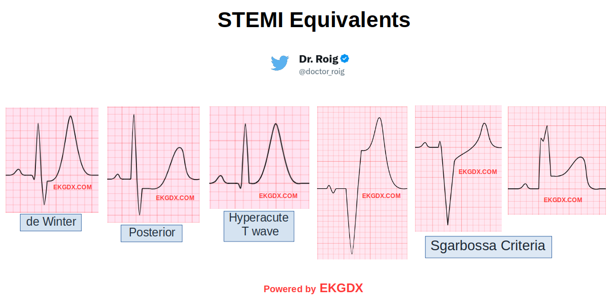 Stemi Total Ischaemic Time In STEMI: Factors Influencing Systemic